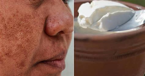 Pigmentation Hatane Ke Gharelu Upay