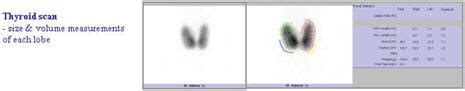 Canterbury District Health Board Thyroid Scan