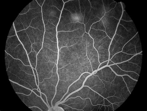 Syphilitic Multifocal Retinitis Retinal Angiography Shows