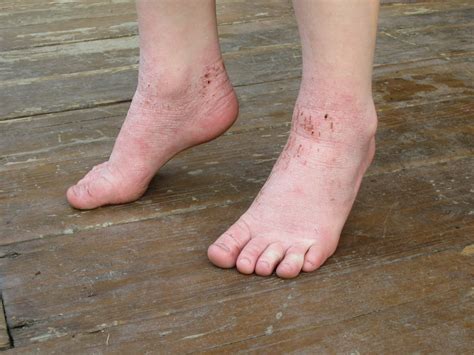 Why Are My Feet So Itchy On Top Printable Templates Protal
