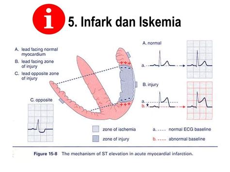 Interpretasi Ekg 12 Leads Infarct And Ischemiapptx