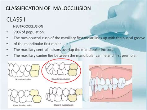 Classification Of Malocclusion Pptx