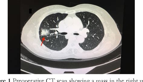 Figure 1 From Unusual Case Of Subxiphoid Uniportal Vats Right Upper Lobectomy In A Patient With