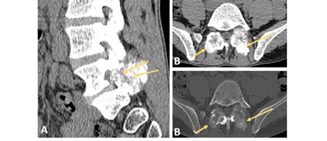 Ct Scan Sagittal View Of The Pelvis A And Axial View Of The Lumbar Download Scientific