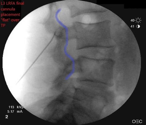 Fluoroscopic Guided Sacroiliac Sij Joint Dorsal Ramus And Lateral