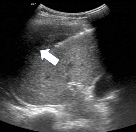An Extremely Rare Case Of Intrahepatic Sarcomatoid Cholangiocarcinoma Pmc
