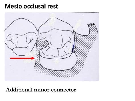 Basic Principles Of Rpd Design I And Ii Pdf