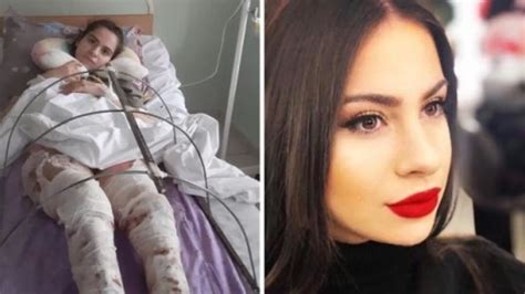 რა გეგმები აქვს გოგოს რომლის დაწვაც შეყვარებულმა სცადა