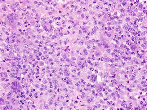 Langerhans Cells Histology Rare Case Of Langerhans Cell Histiocytosis