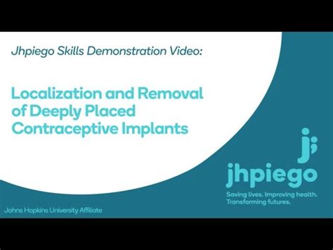 Skills Demonstration Video Of Localization And Removal Of Deeply Placed Contraceptive Implants