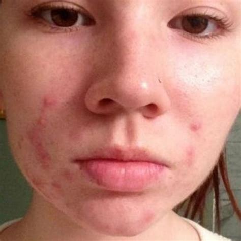 Kenalog Injections For Acne In Mississauga Fast Relief