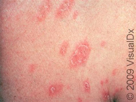Pityriasis Rosea Condition Treatments And Pictures For Teens Skinsight