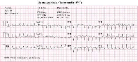 Atrial Tachycardia Causes Symptoms Diagnosis Treatment