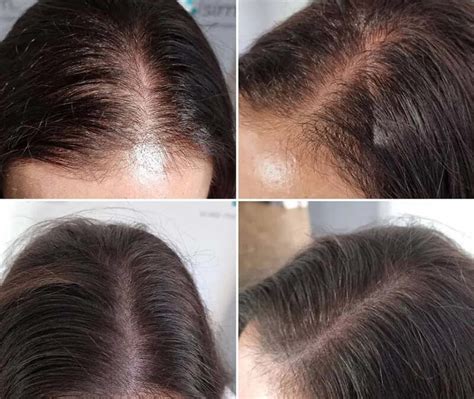 What Is Scalp Pigmentation Cosmetict Tattoo And Personal Care