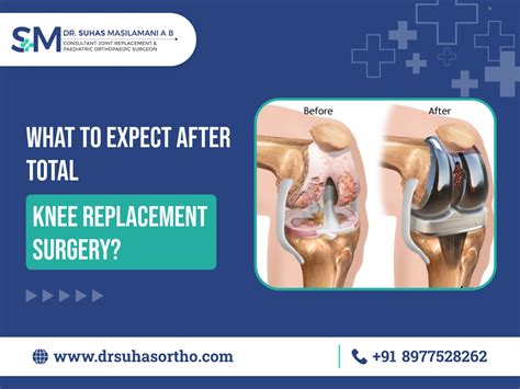 What To Expect After Knee Replacement Surgery Dr Suhas Masilamani