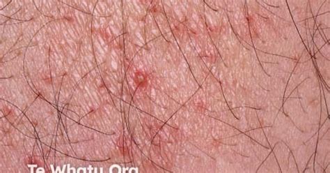 Folliculitis Image