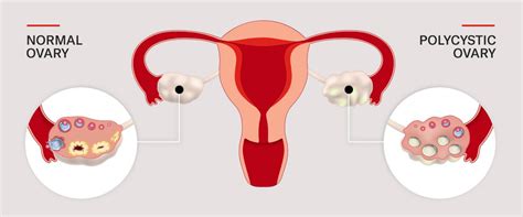 All About Polycystic Ovary Syndrome Pcos