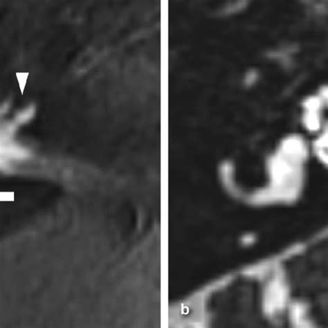 Severe Vestibular And Cochlear Hydrops In A 44 Year Old Man With