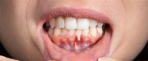 Gum Recession Causes Treatment And Prevention The Perfect Smile