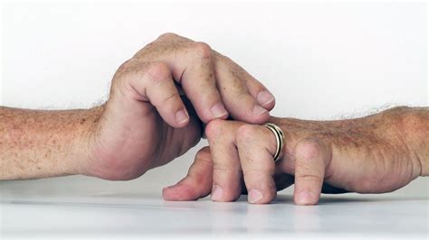 Rheumatoid Arthritis Hands