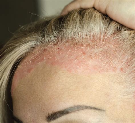 Psoriasis In Sensitive Areas