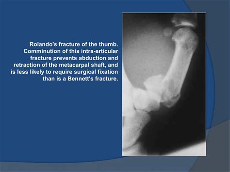 Bone Trauma Common Fractures Long Boneppt