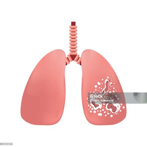 결핵에 감염된 건강한 폐와 폐 바이러스 또는 세균은 폐를 감염 폐의 폐렴을 일으키는 코로나 바이러스 폐렴을 일으키는 바이러스 2019ncov 코로나 바이러스 전염병