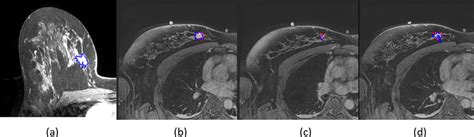 Prone And Supine Breast Mr Imaging With Segmented Tumor The Blue Line