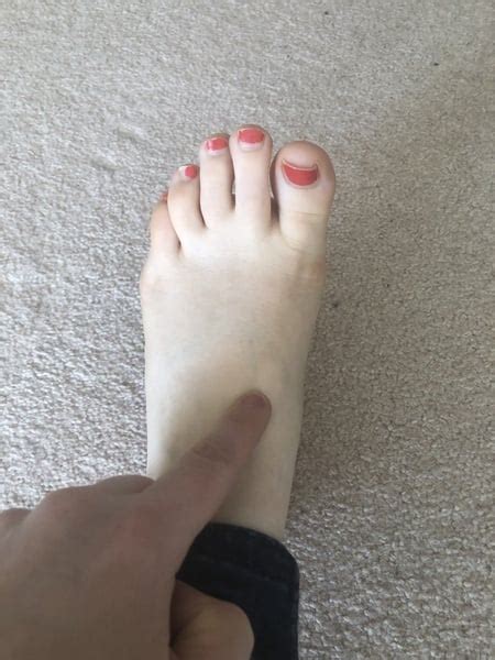 Hard Lump On Foot Feels Like Bone Shop