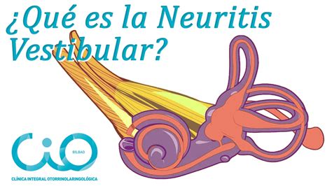 ¿neuritis Vestibular ¿vértigo Otorrinos Cio Bilbao Youtube