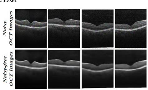 Figure 1 From Retinal Optical Coherence Tomography Image Denoising
