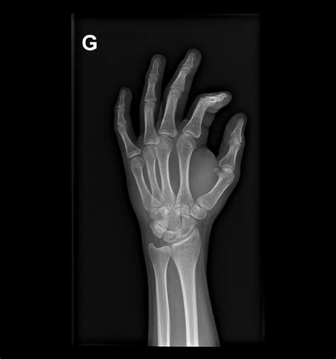 Can Someone See The Non Displaced Fracture Im Supposed To Have In The Basal Region Of My 5th