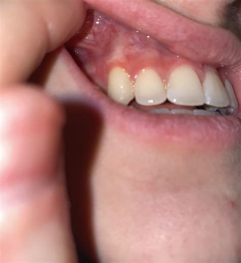 Gums Very Red And Thin Raskdentists