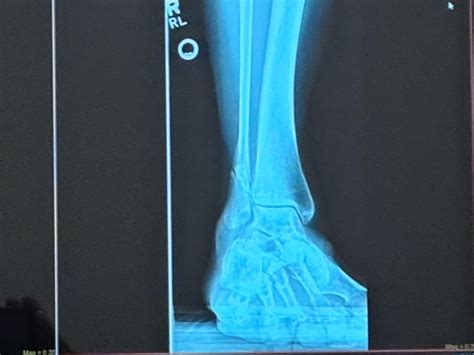 Shin Splint Feeling When Walking 4 Weeks 4 Days Post Orif Tib And Fib