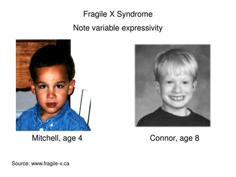 PPT Fragile X Syndrome PowerPoint Presentation Free Download ID