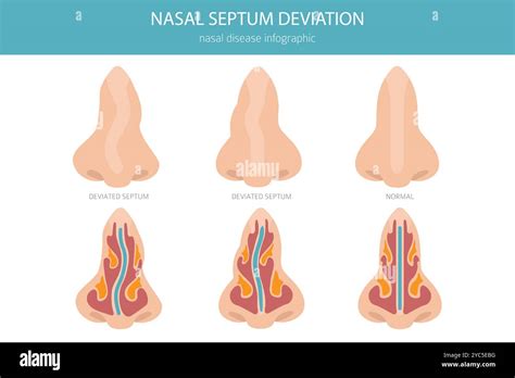 Nose Deviated Septum Nasal Diseases Medical Infographic Design