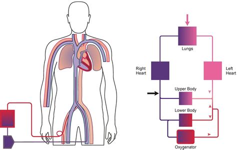 Configurations Of ECMO Alfred ECMO Guideline