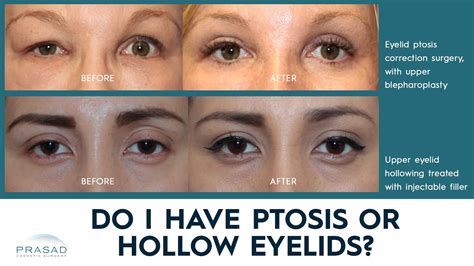 Eyelid Ptosis And Hollow Upper Eyelids Different Causes And