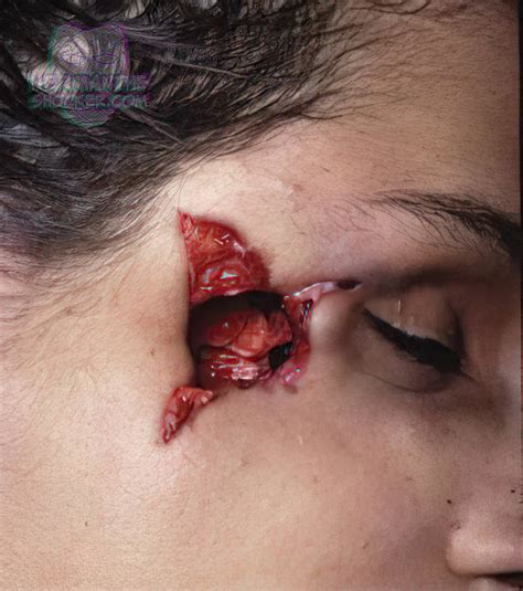 History Of Gunshot Wound At Amanda Edmondson Blog