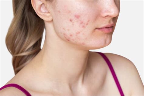 What Is Nodular Acne Causes Treatments Options And Prevention Tips Sutvakclinic