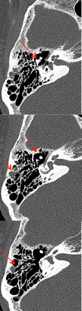 Ossicular Dislocation