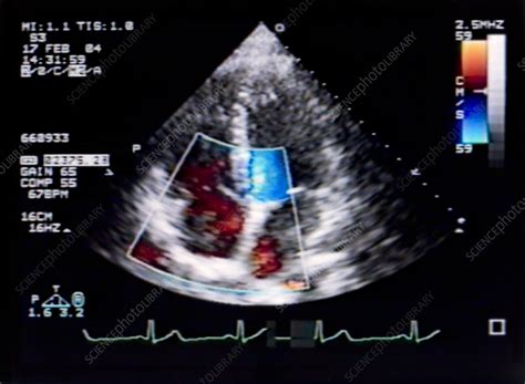Echocardiogram