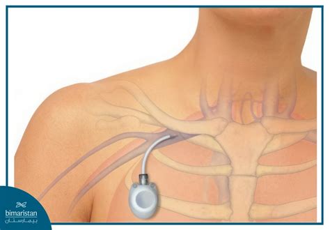 Port Catheter Placement Central Venous Access In Turkey