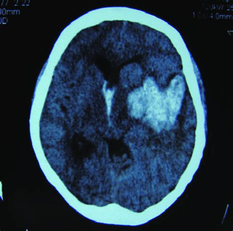 Non Contrast Ct Scan Shows A Spontaneous Hyperdensity Of The Right Download Scientific Diagram
