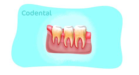 Periodontite Avancada