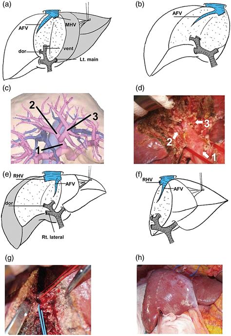 Anatomic Liver Resection Of Right Paramedian Sector Ventral And Dorsal