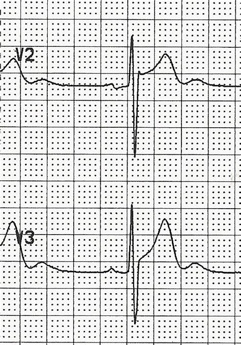Early Repolarization Ecg Guru Instructor Resources
