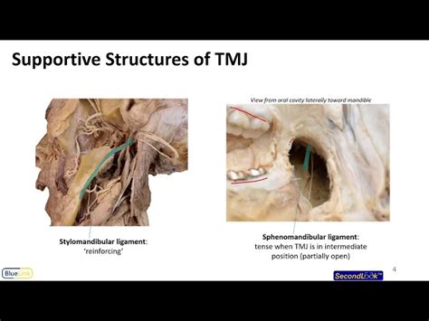 Sphenomandibular Ligament Cadaver
