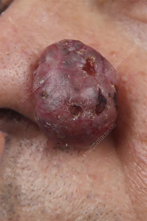 Nodular Bcc Understanding The Importance Of Daily Imaging In The