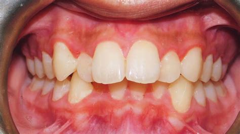 Class Ii Division 1 Malocclusion Excessive Overjet Protruded And